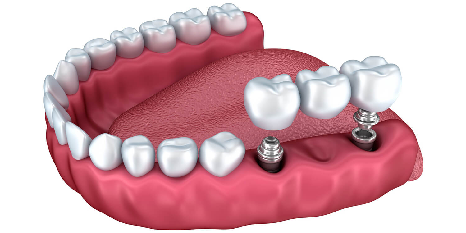 Klikgebit in de bovenkaak - Blog - Implantologiepraktijk Garderen